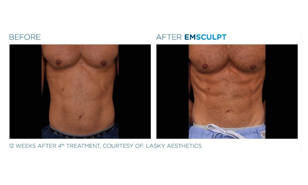 Body Sculpting by EMSCULPT | Columbus, OH | Columbus EMSCULPT
