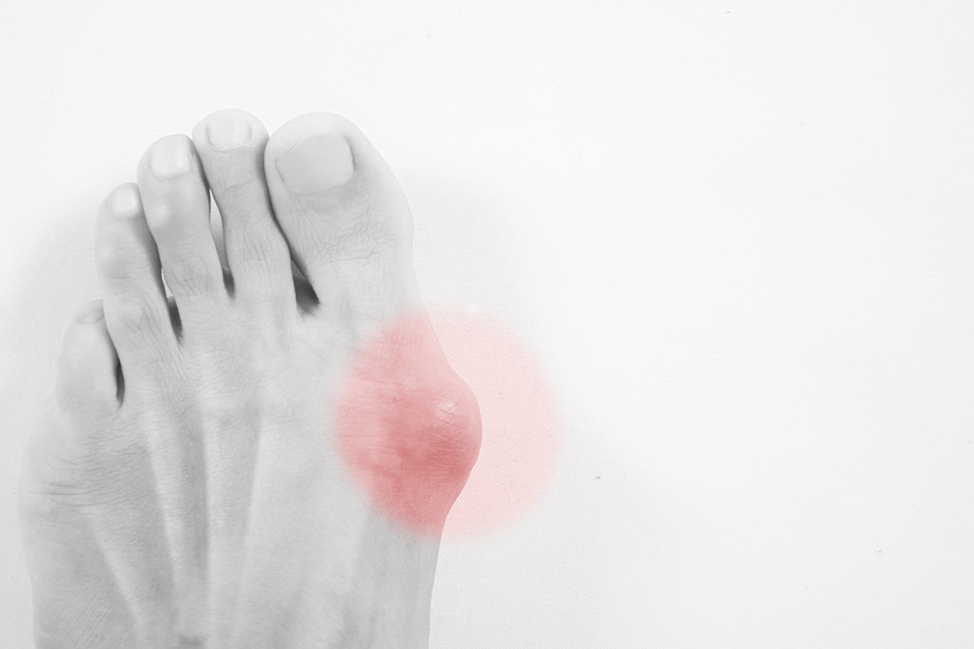Doctor for Bunions in Baton Rouge | Baton Rouge Bunion Surgeon