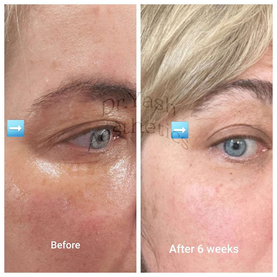 Plasma treatment | Dr Yash Aesthetics