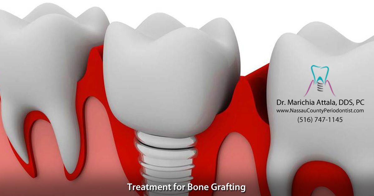 Bone Grafting Treatment by Periodontist, Dr. Marichia Attalla