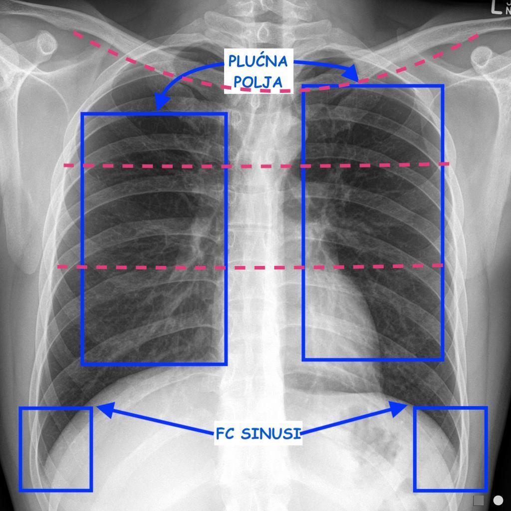 INTERPRETACIJA RTG P/C