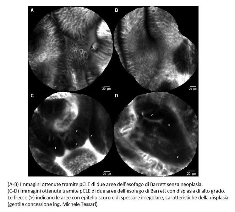 Classificazione polipi - Roma - Dott. Prof. Antonio Iannetti - Polipi ...