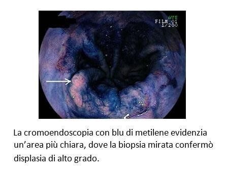 Classificazione polipi - Roma - Dott. Prof. Antonio Iannetti - Polipi ...