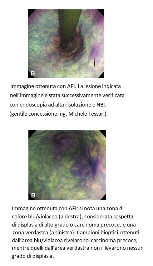 Classificazione polipi - Roma - Dott. Prof. Antonio Iannetti - Polipi ...