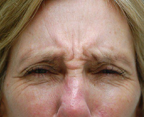 Dynamic vs. Static Wrinkles: What Are The Treatments?