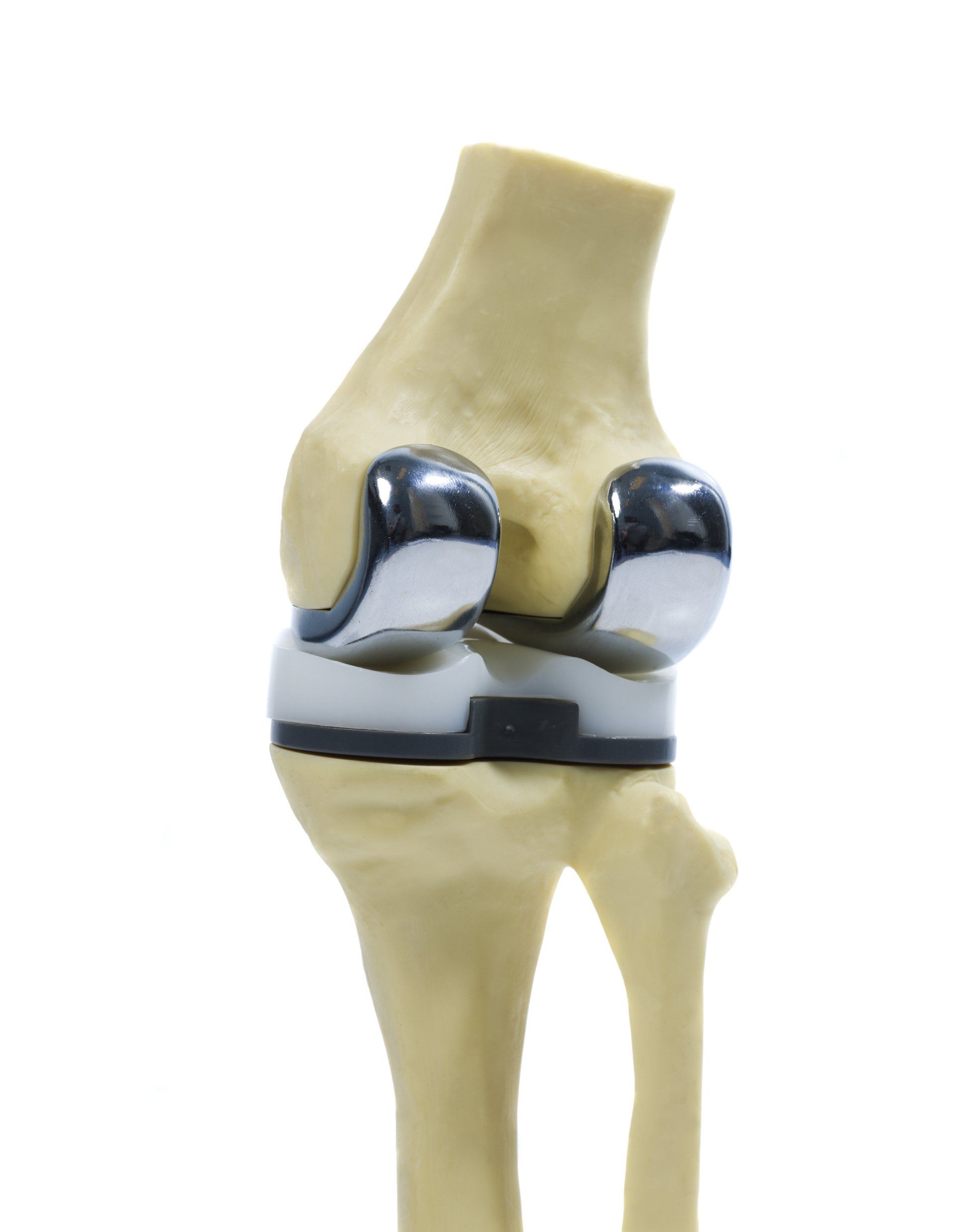 Total Knee Replacement (TKR) | Dr A. Theodorides Knee Surgeon Specialist