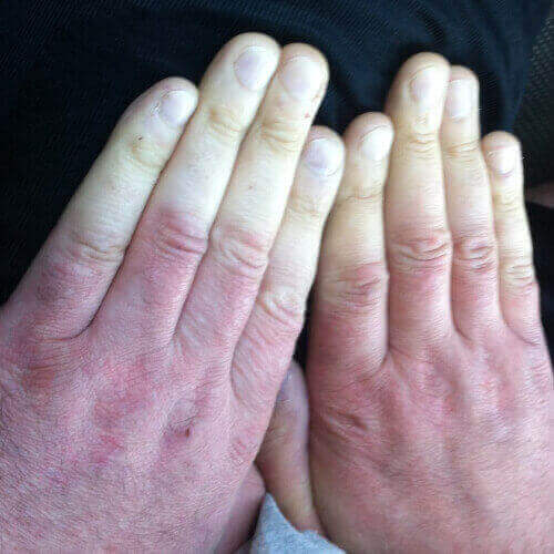 What Is Hand Arm Vibration Syndrome What Is Hand Arm Vibration Syndrome