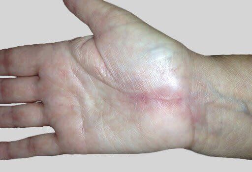 Carpal Tunnel Surgery Scar