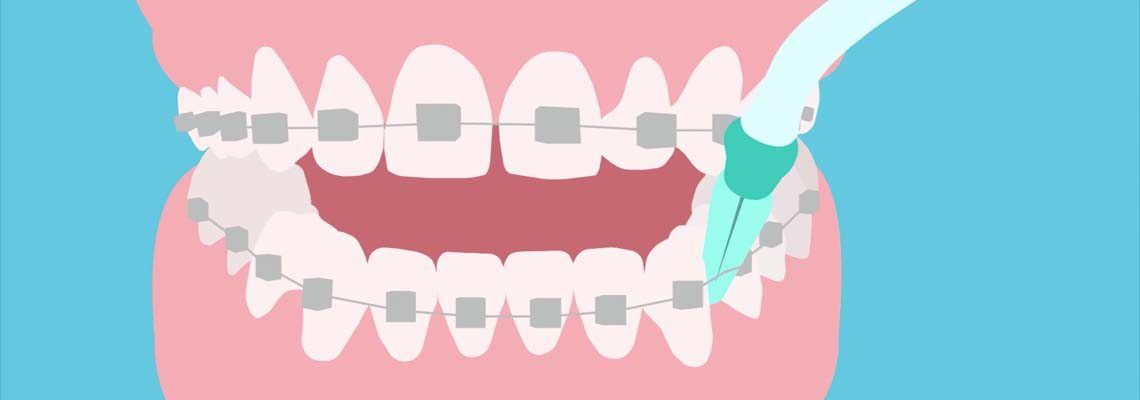 How to brush with braces