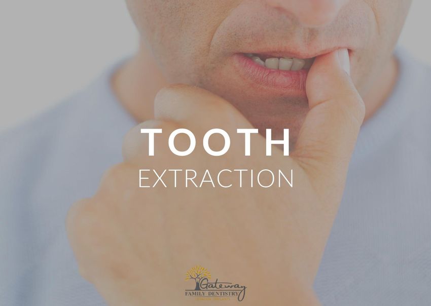 DENTAL EXTRACTION: 3 SIGNS YOU MIGHT NEED THAT TOOTH PULLED