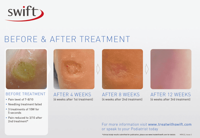 Swift microwave verruca treatment in Lurgan, Craigavon, Northern Ireland