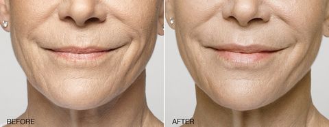 Galderma Fillers
