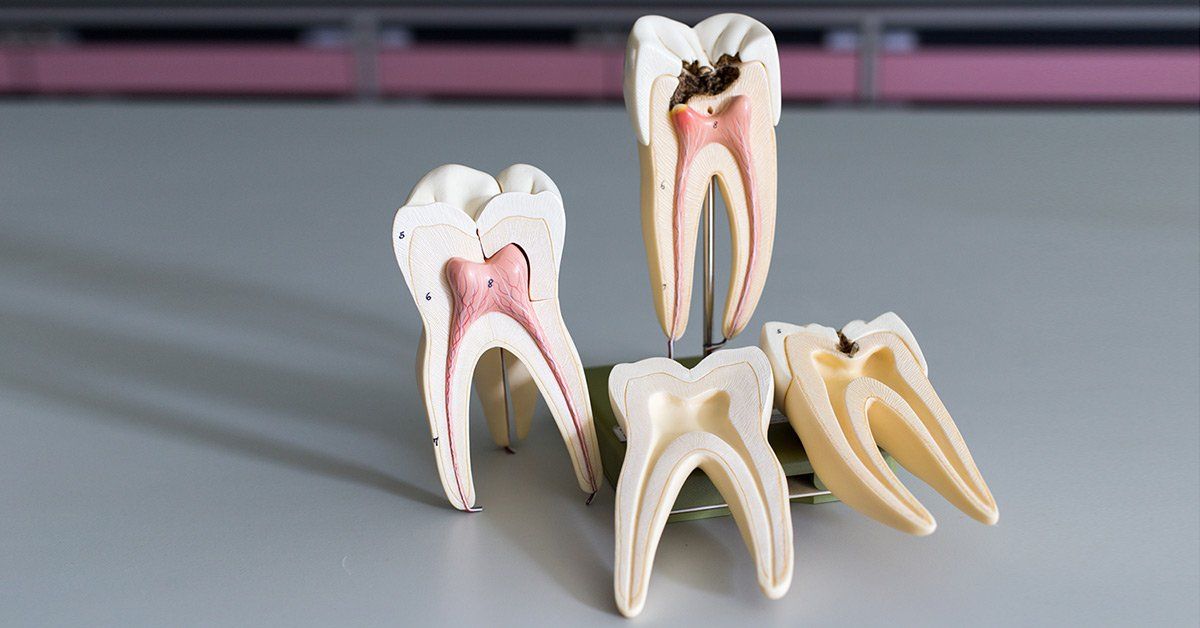 The 101 on Root Canals and Root Canal Therapy