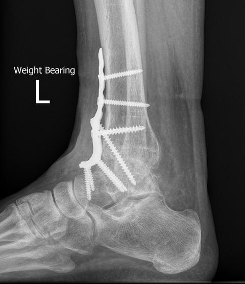 Ankle Fusion Surgery | Dr Ben Beamond | Orthopaedic Surgeon | Adelaide