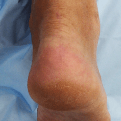 Achilles SpeedBridge | Dr Ben Beamond | Orthopaedic Surgeon | Adelaide