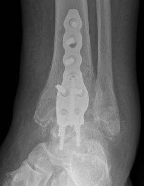 Ankle Fusion Surgery | Dr Ben Beamond | Orthopaedic Surgeon | Adelaide