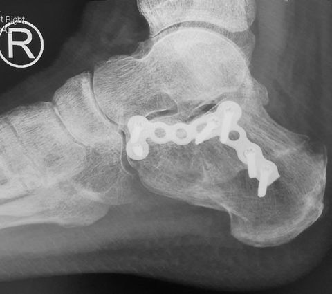 Calcaneus Fractures | Dr Ben Beamond | Orthopaedic Surgeon | Adelaide