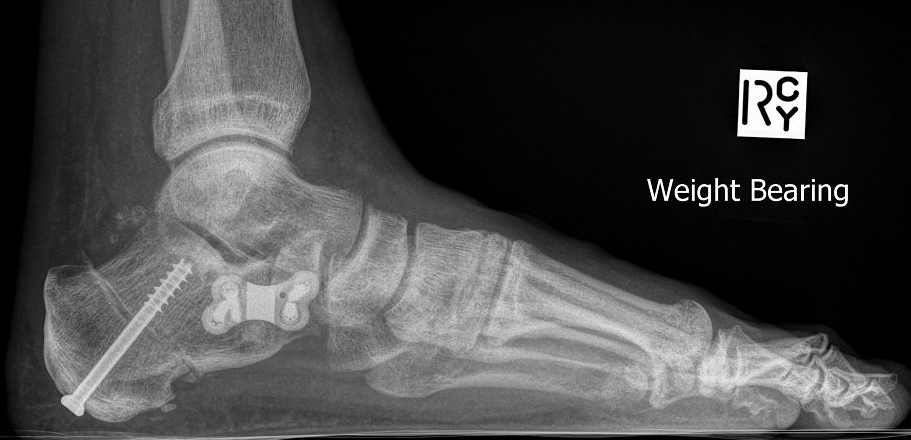 Flat Foot Reconstruction | Dr Ben Beamond | Orthopaedic Surgeon | Adelaide