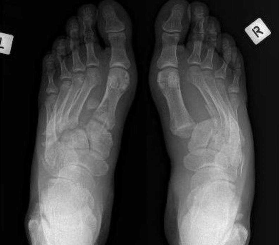 Lisfranc Midfoot Injury | Dr Ben Beamond | Orthopaedic Surgeon | Adelaide