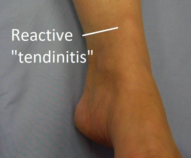 Ankle Tendon | Dr Ben Beamond | Orthopaedic Surgeon | Adelaide