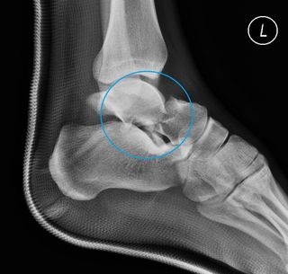 Tatus Fractures | Dr Ben Beamond | Orthopaedic Surgeon | Adelaide