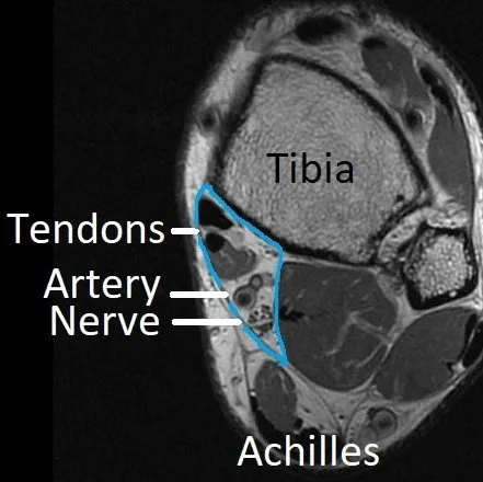 Tarsal Tunnel Syndrome | Dr Ben Beamond | Orthopaedic Surgeon | Adelaide