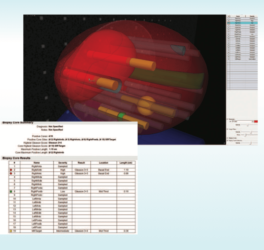 Methoden der Prostatabiopsie
