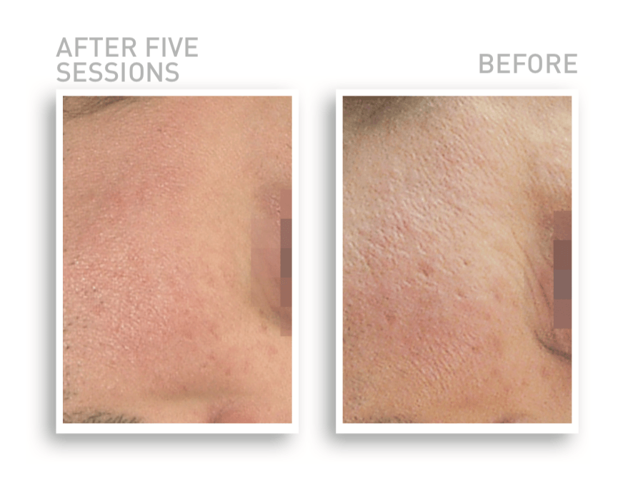 Prx T33 Treatments In Chicago Dr Yates Lifestyle Med Spa
