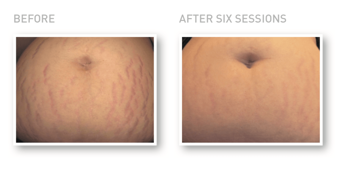 Prx T33 Treatments In Chicago Dr Yates Lifestyle Med Spa