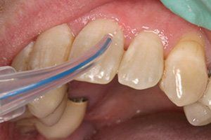 Laser Dentistry | Sterling | Potomac Falls Family Dentistry