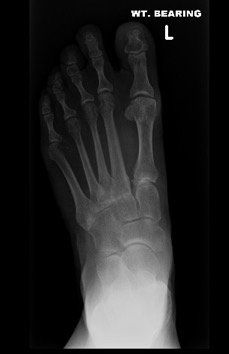 Midfoot Arthritis