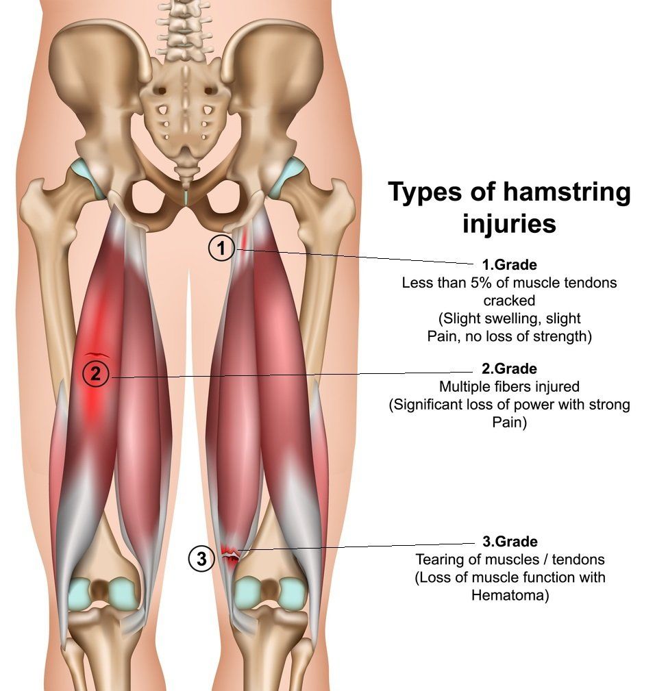 Differentiation Of Hamstring Tendonitis And Strains Vs Hamstring Syndrome 