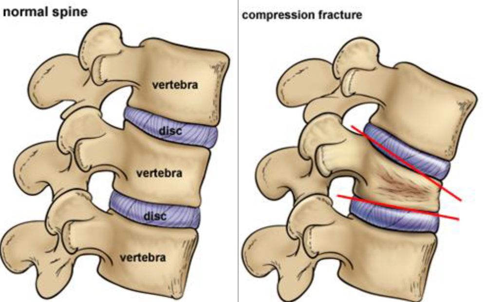 Kyphoplasty | OrthoSpine Advance Health, Inc. | Merced, CA