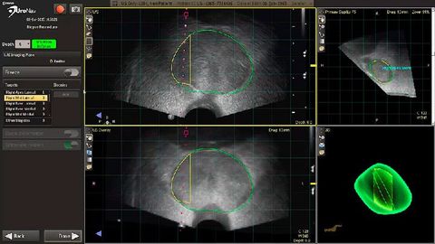 Prostate Biopsy- Smart Biopsy | San Antonio | The Urology Place