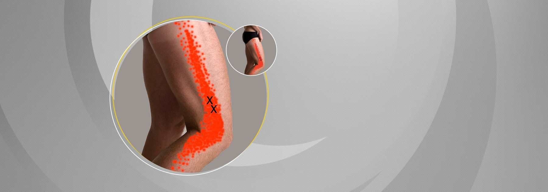 Trigger Point Release Therapy | Management of Pain | Lincoln, NE