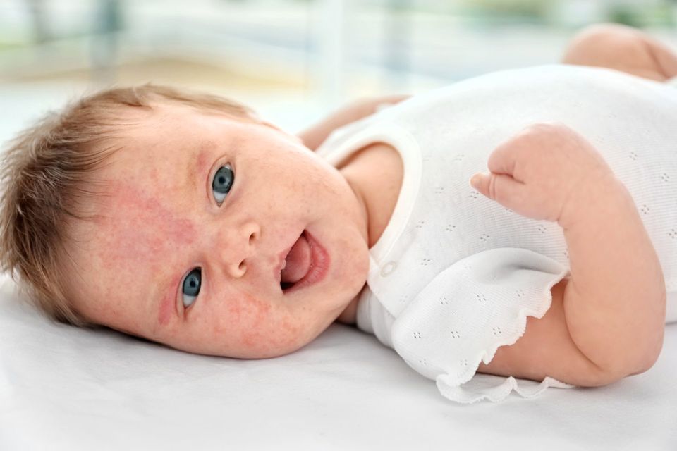 Recognizing Food Allergies In Babies How To Identify Avoid Infant 