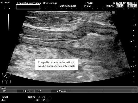 Ecografia anse intestinali - Catania - Trecastagni - Pachino - Dott ...