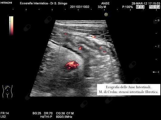 Ecografia anse intestinali - Catania - Trecastagni - Pachino - Dott ...