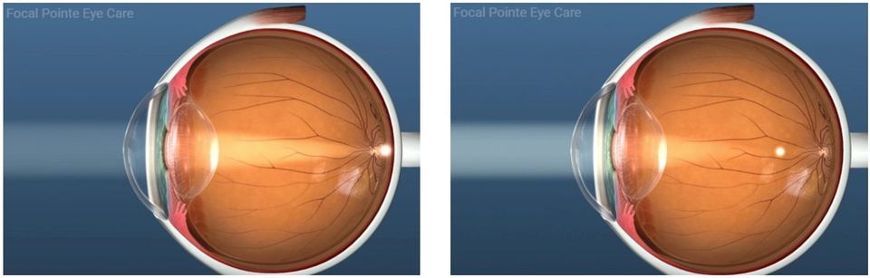 Is My Child Nearsighted or Myopic Is My Child Nearsighted or Myopic