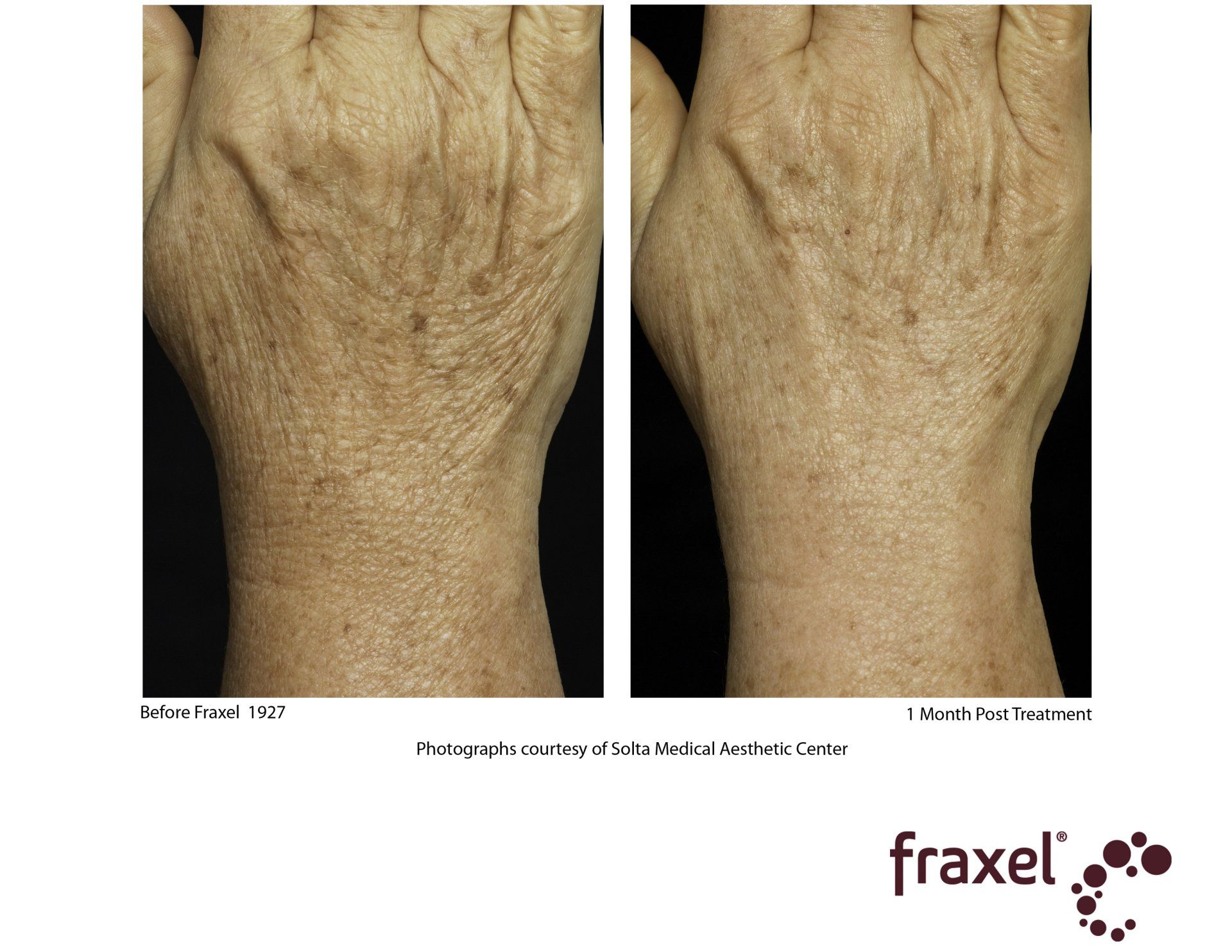 California Coastal Dermatology | Fraxel®