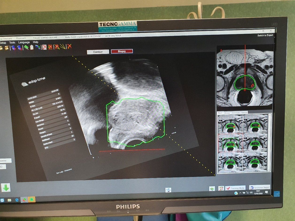 La biopsia prostatica