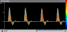 Viasonix Falcon Pro | Peripheral Vascular Diagnostic System | IMI USA