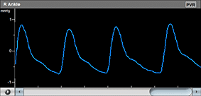 Viasonix Falcon Pro | Peripheral Vascular Diagnostic System | IMI USA