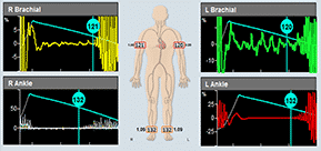 Viasonix Falcon Pro | Peripheral Vascular Diagnostic System | IMI USA