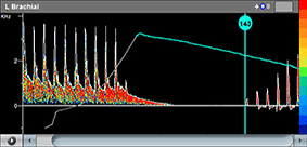 Viasonix Falcon Pro | Peripheral Vascular Diagnostic System | IMI USA