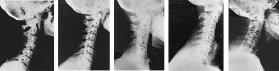The Cervical Curve Structure, Function and Optimal Health