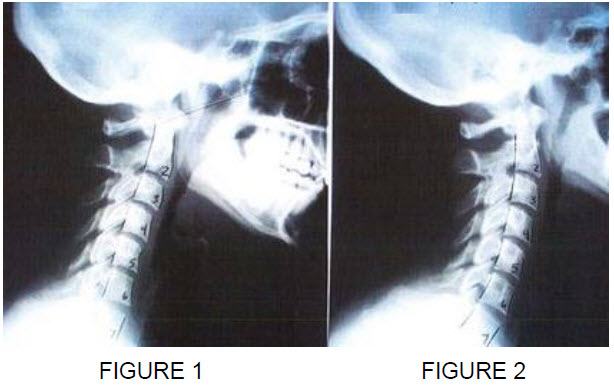 The Cervical Curve Structure Function And Optimal Health